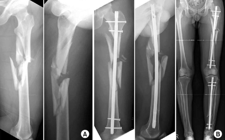 Comminuted fracture definition, causes & treatment