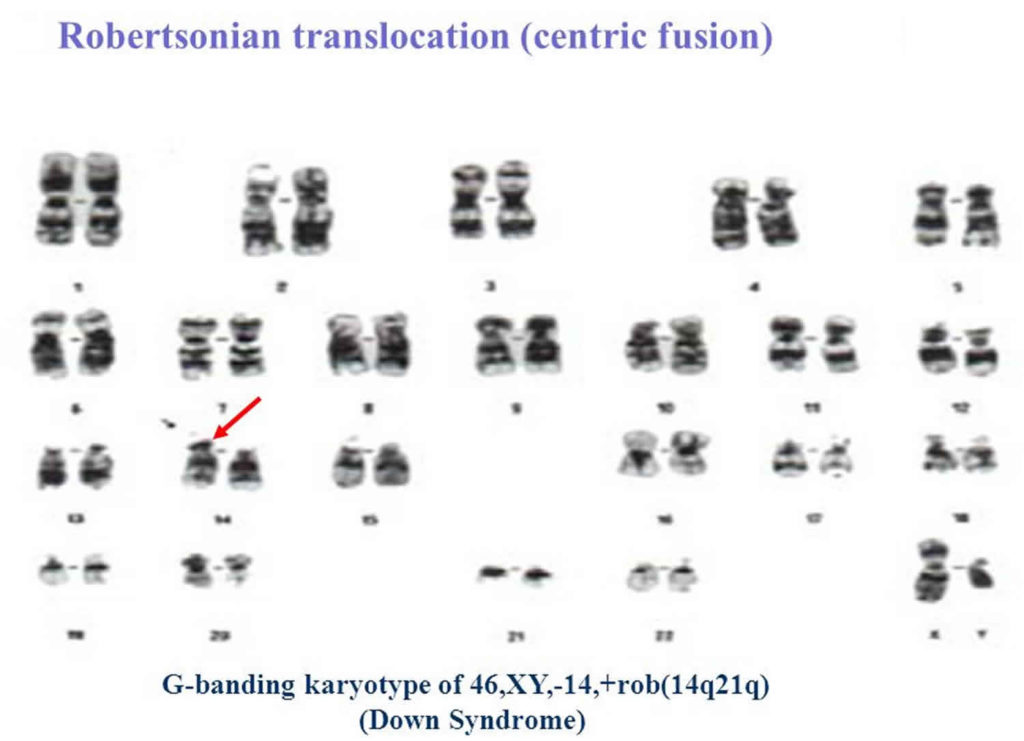 Translocation Down syndrome causes, symptoms, diagnosis & treatment