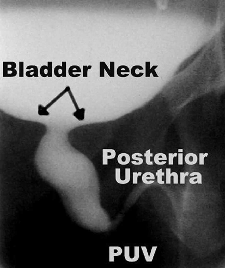 Posterior urethral valves causes, symptoms, diagnosis, treatment ...