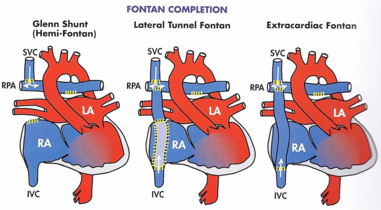 Fontan procedure, uses, types, recovery & complications