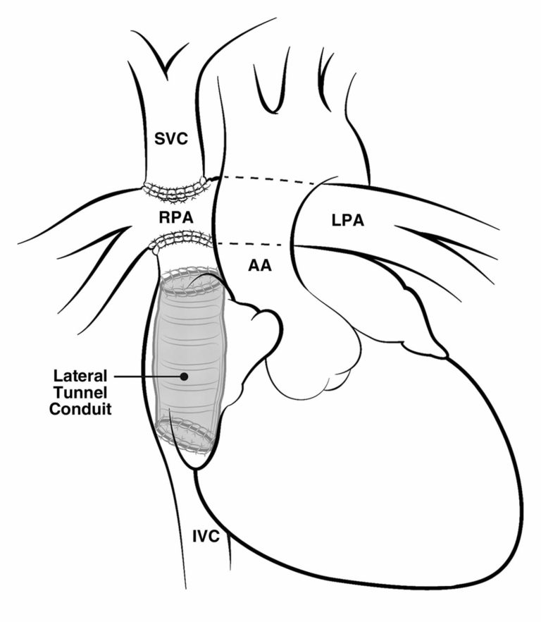 Fontan procedure, uses, types, recovery & complications