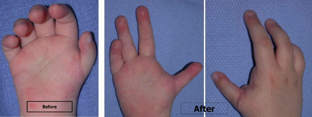 Thumb hypoplasia causes, classification, diagnosis & treatment