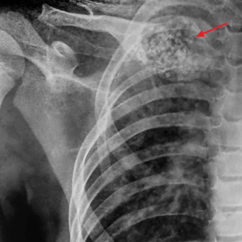 Aneurysmal bone cyst causes, symptoms, diagnosis, treatment, recurrence ...