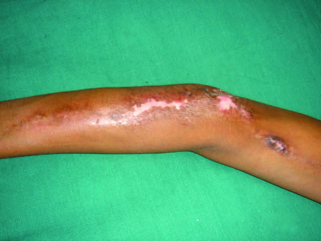 Linear scleroderma causes, symptoms, diagnosis, treatment & prognosis