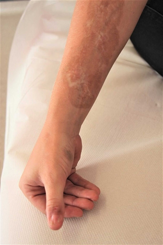 Linear scleroderma causes, symptoms, diagnosis, treatment & prognosis